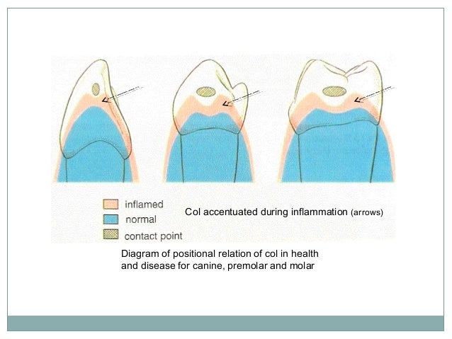 Mucus Seal On Gum _ Mucous cyst: Types, causes, and treatment – EHTN