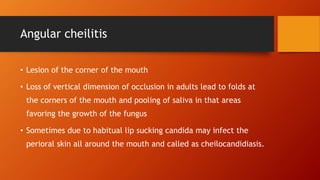 Oral mycotic (fungal)infections | PPTX