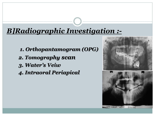 Oral Myiasis | PPTX