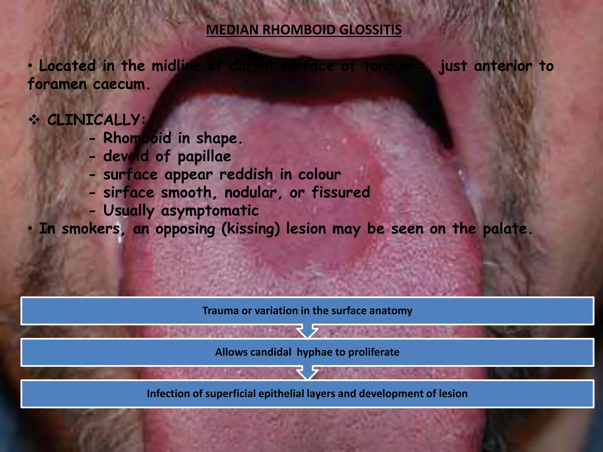 Oral pathology ... fungal infections 2 | PPTX