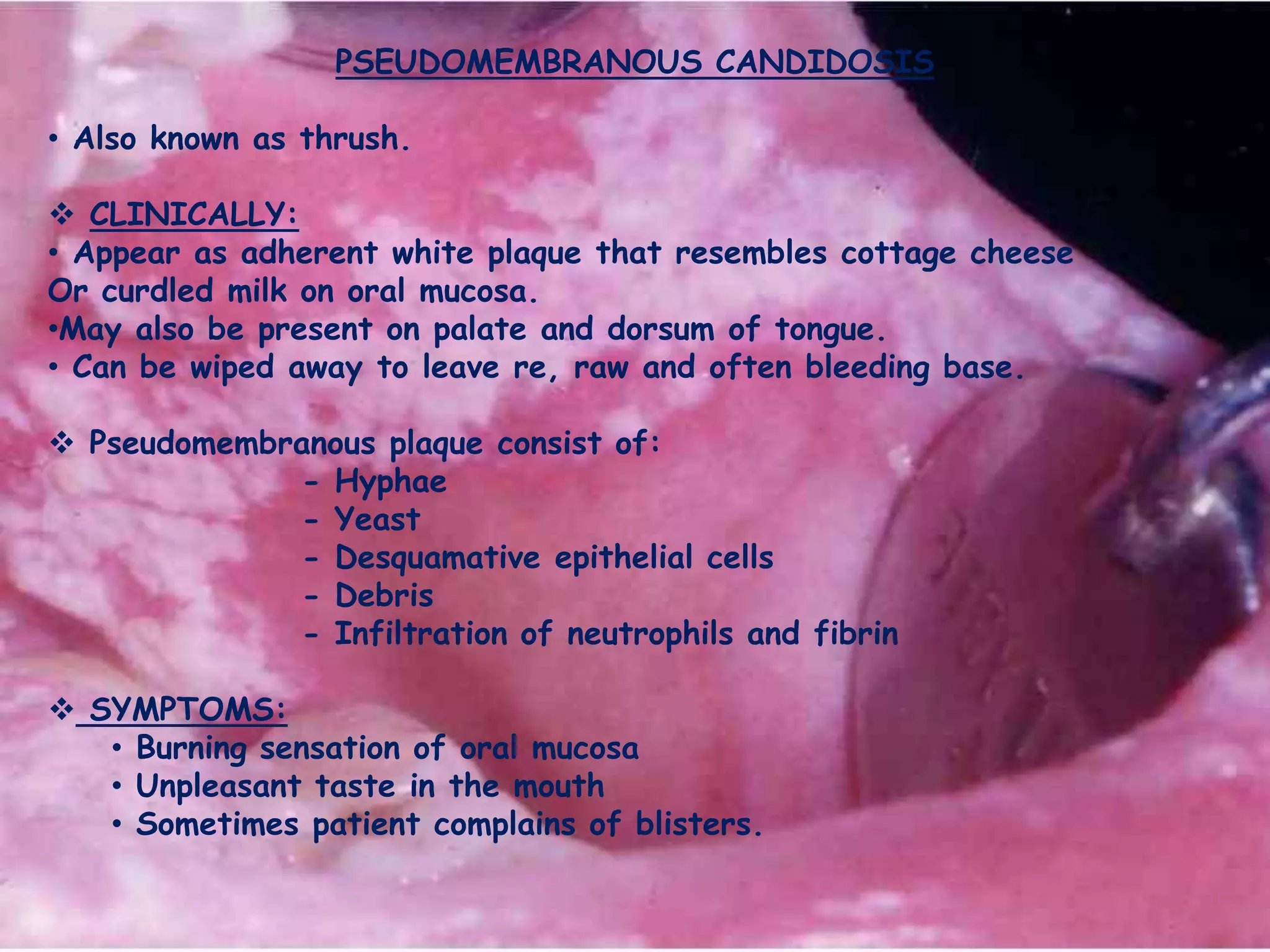 Oral pathology ... fungal infections 2 | PPTX