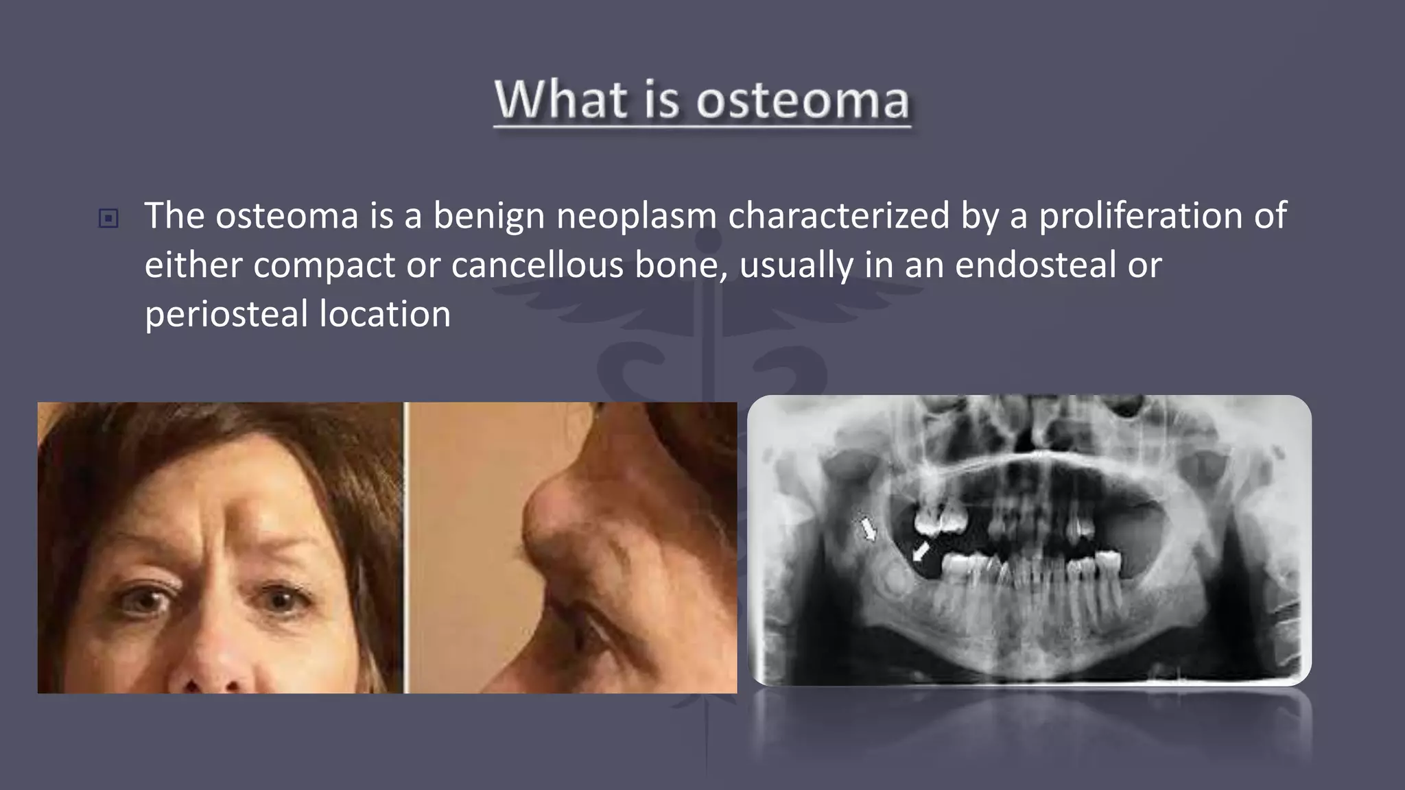 Oral pathology osteoma,chondroma,myxoma | PPTX