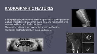 Oral pathology osteoma,chondroma,myxoma | PPTX