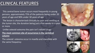 Oral pathology osteoma,chondroma,myxoma | PPTX