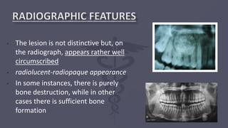 Oral pathology osteoma,chondroma,myxoma | PPTX
