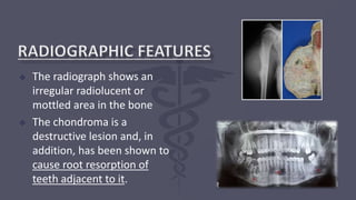 Oral pathology osteoma,chondroma,myxoma | PPTX