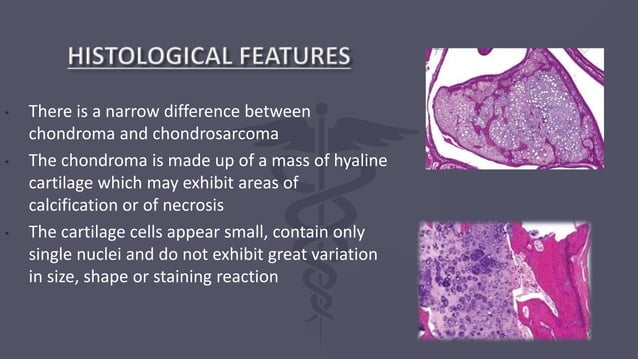 Oral pathology osteoma,chondroma,myxoma | PPTX
