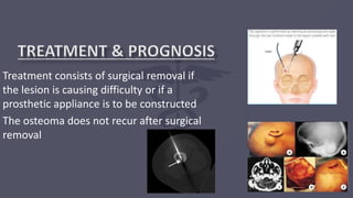 Oral pathology osteoma,chondroma,myxoma | PPTX