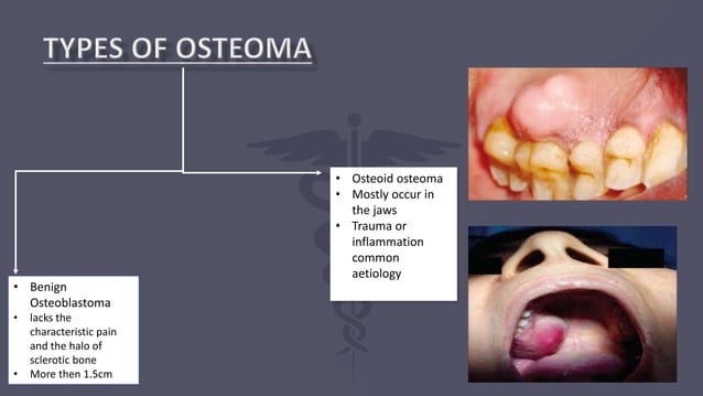 Oral pathology osteoma,chondroma,myxoma | PPTX
