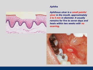 Aphthous Stomatitis Histology