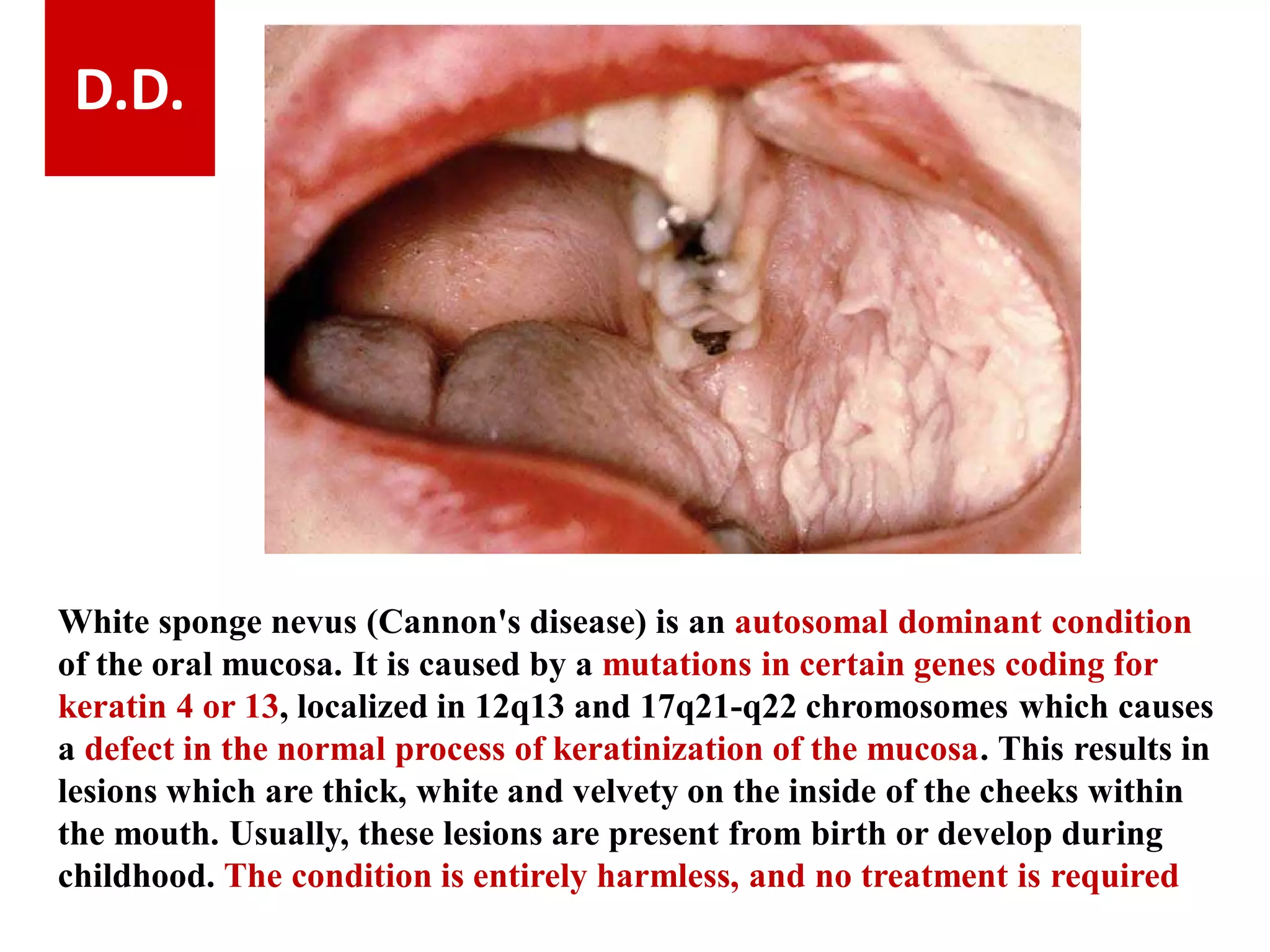 precancerous lesions in oral cavity | PDF