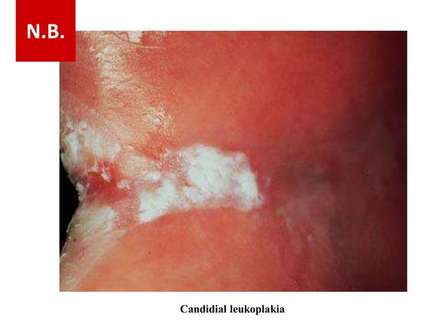 Precancerous Lesions In Oral Cavity Pdf