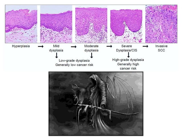 precancerous lesions in oral cavity | PDF