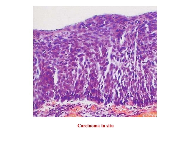 Precancerous Lesions In Oral Cavity Pdf