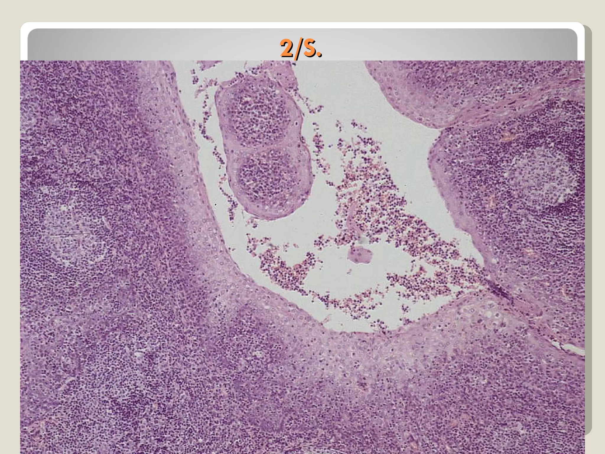 Oral+pathology+pathology+of+the+oral+mucosa+and+pharynx | PPT