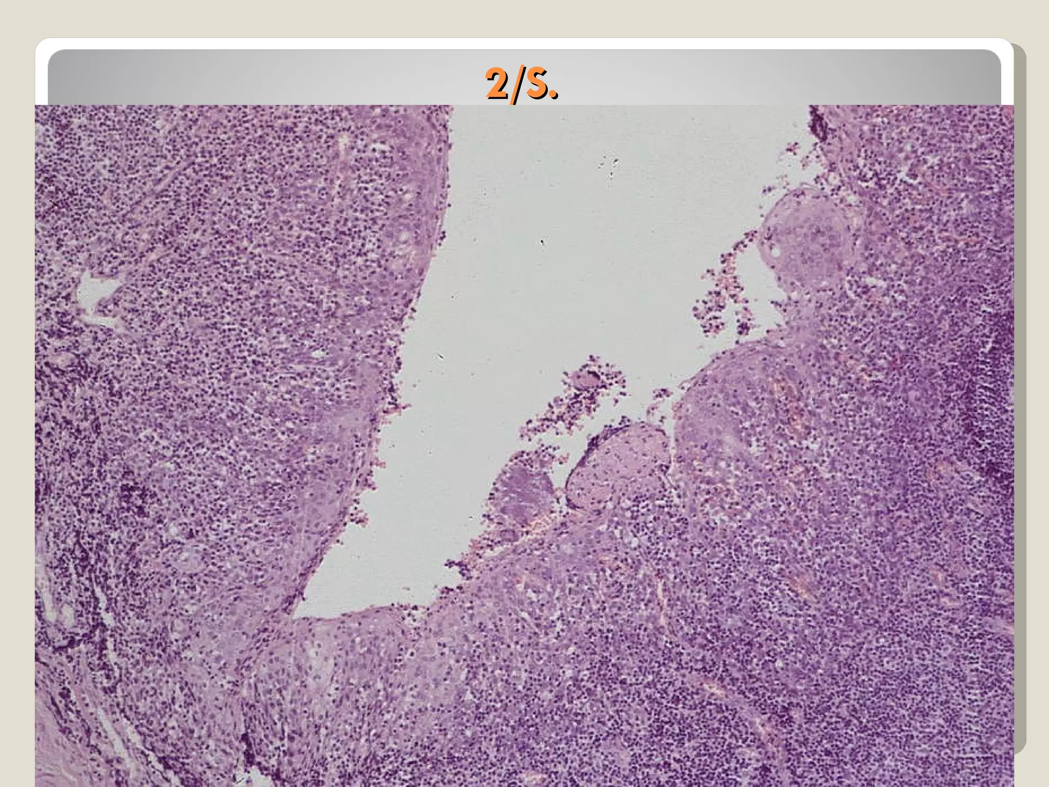 Oral+pathology+pathology+of+the+oral+mucosa+and+pharynx | PPT