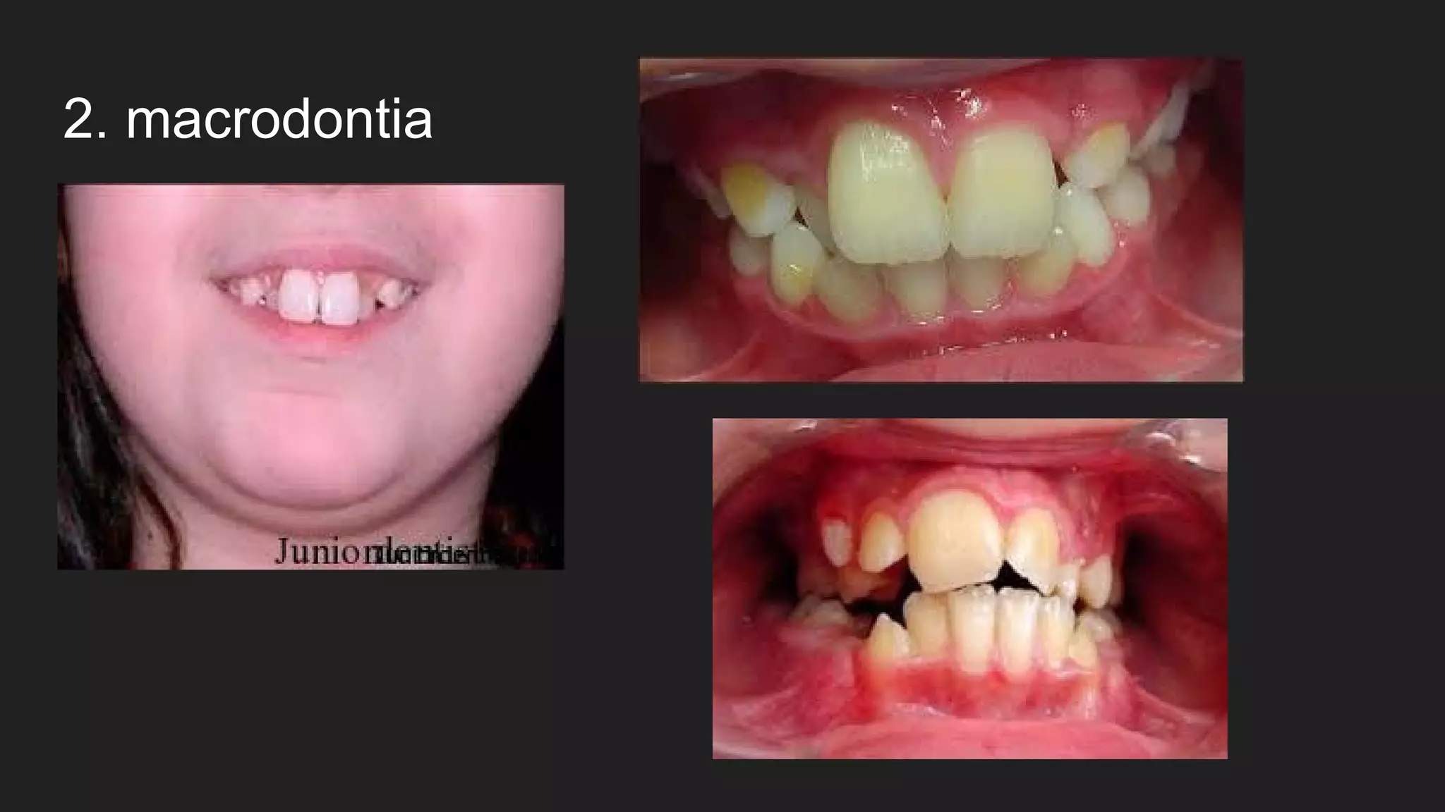 Developmental disorders of teeth and related tissues. | PPT | Free Download