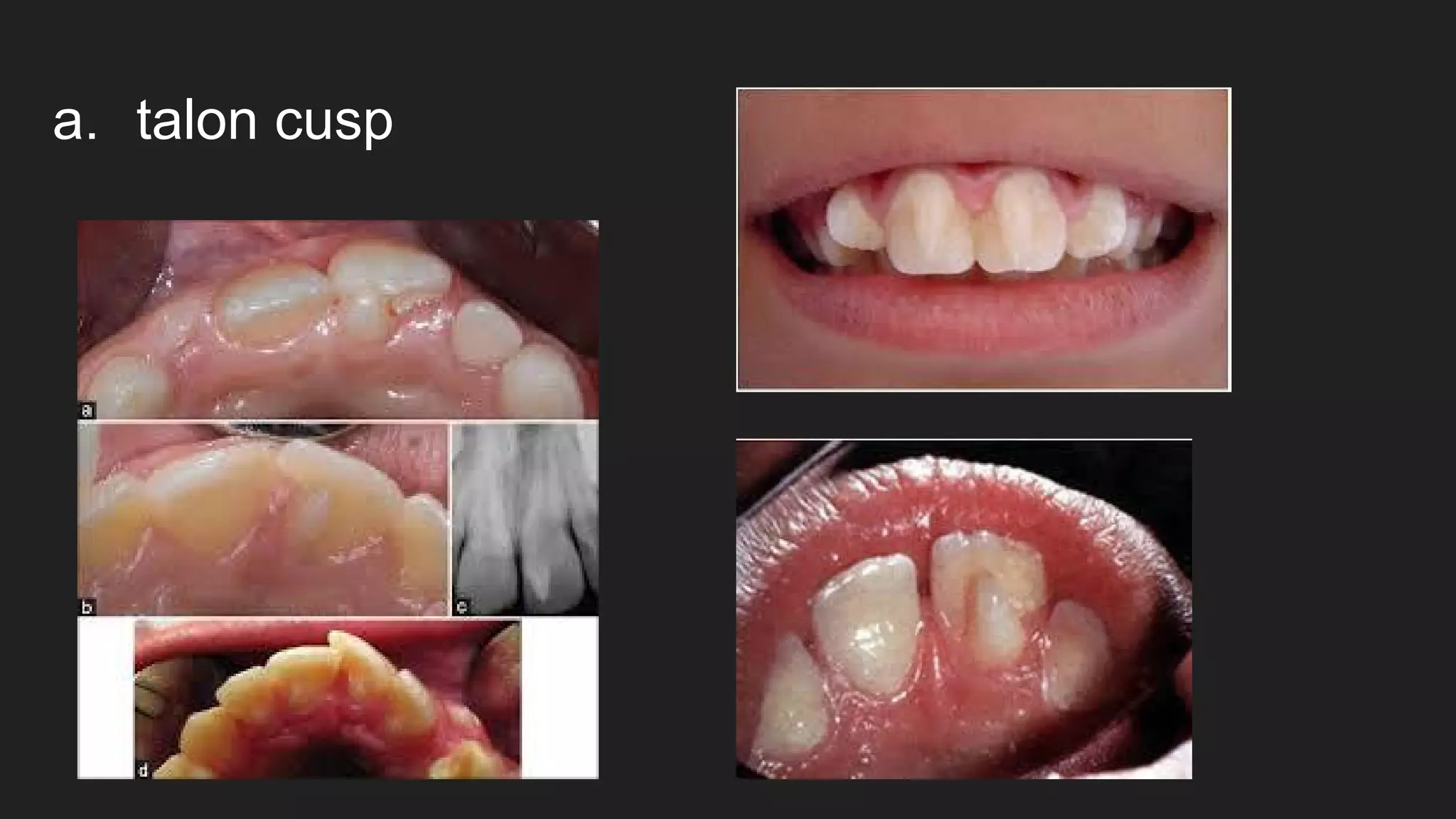 Developmental disorders of teeth and related tissues. | PPT | Free Download