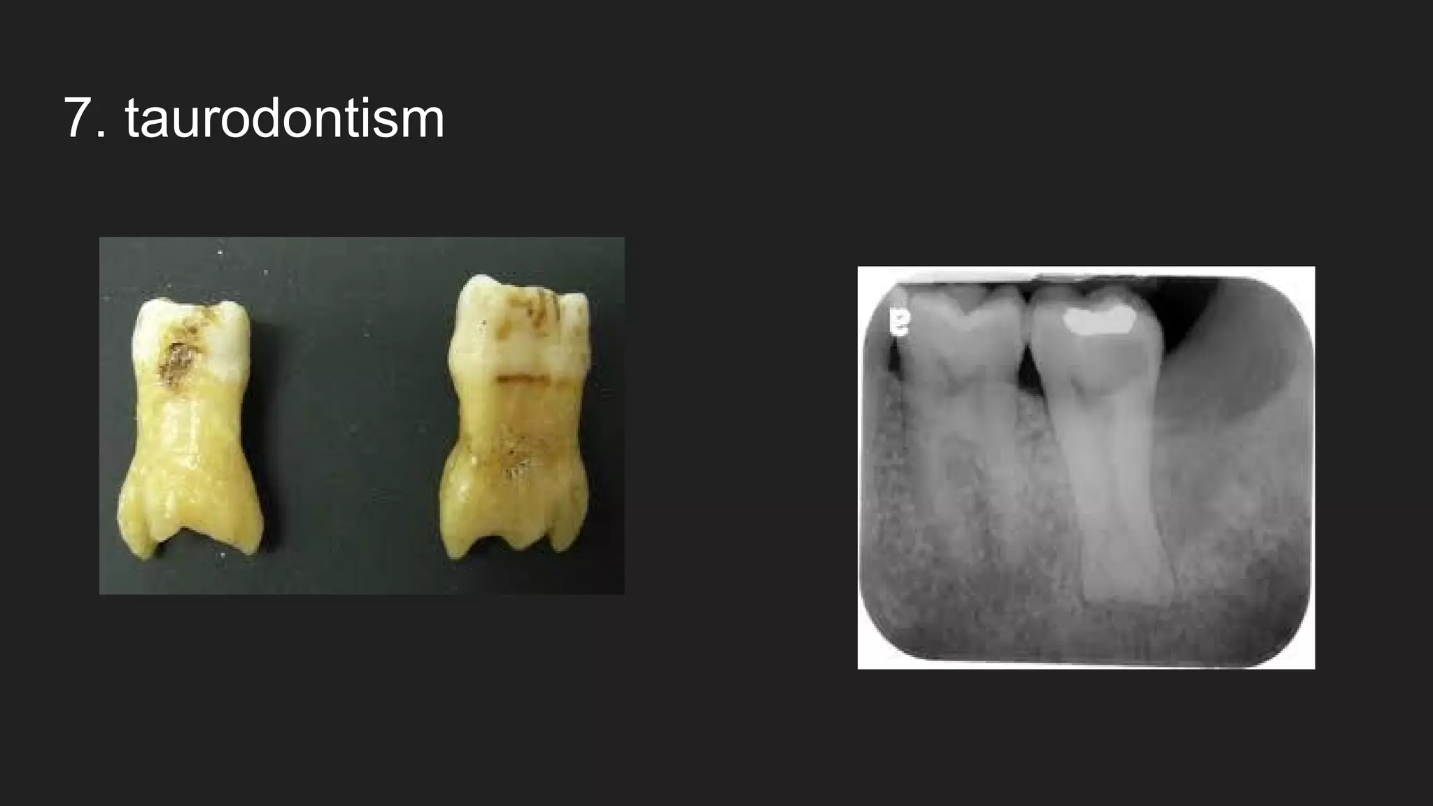 Developmental disorders of teeth and related tissues. | PPT | Free Download