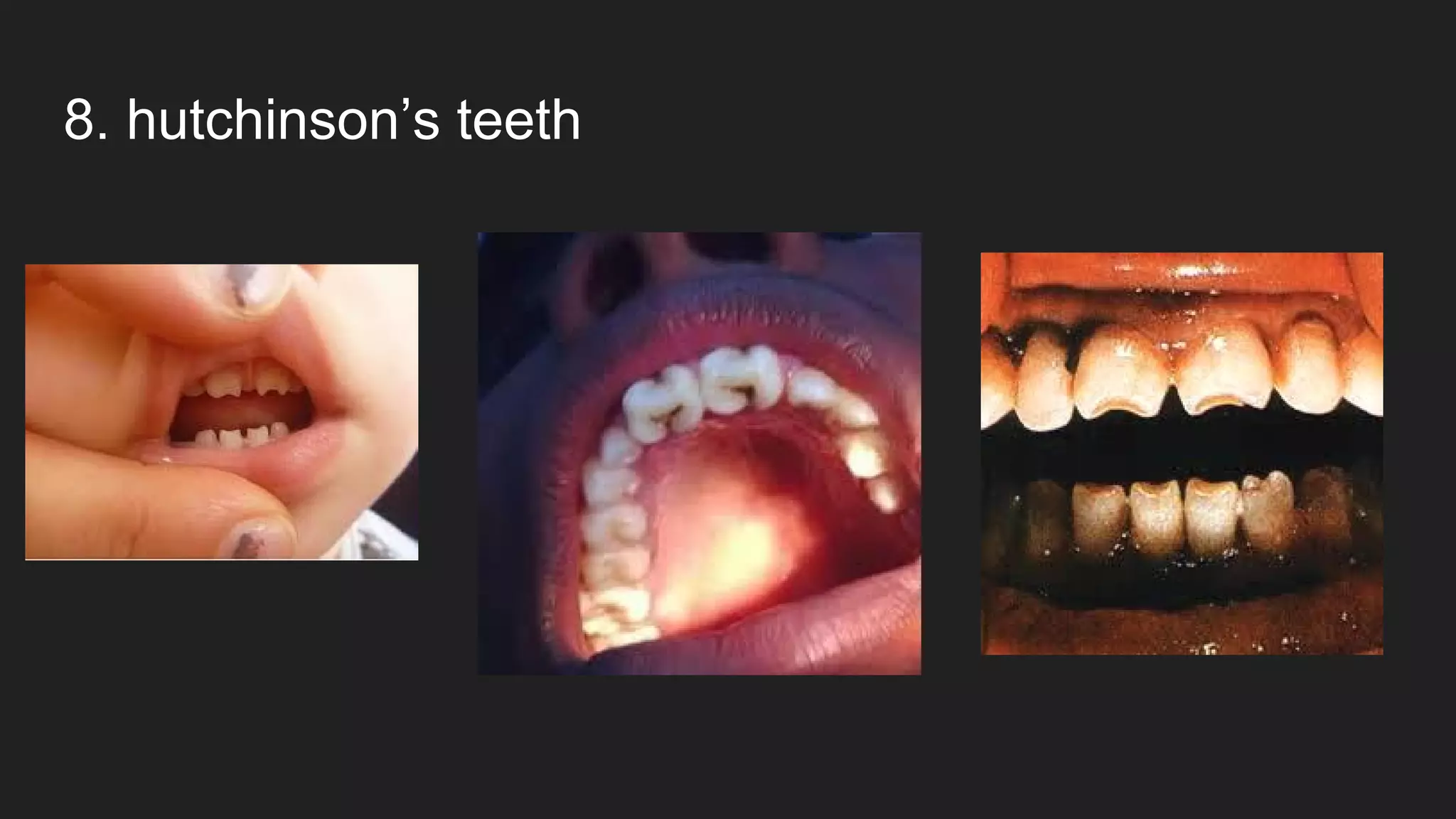 Developmental disorders of teeth and related tissues. | PPT