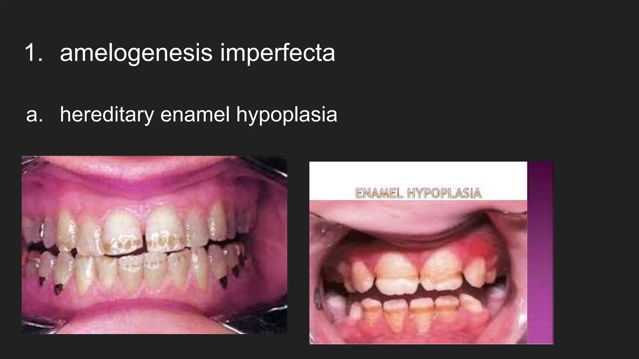 Developmental disorders of teeth and related tissues. | PPT | Free Download