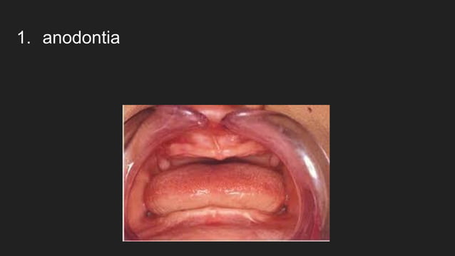 Developmental disorders of teeth and related tissues. | PPT | Free Download