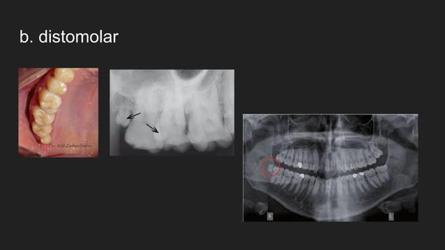 Developmental disorders of teeth and related tissues. | PPT | Free Download