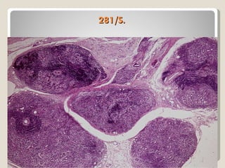 Oral+pathology+salivary+glands+pathology | PPT