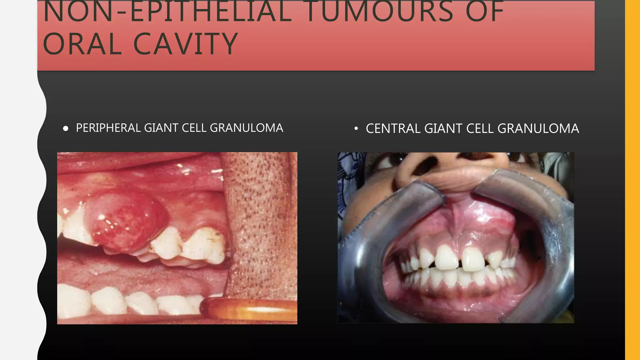 Peripheral and central giant cell granuloma | PPTX