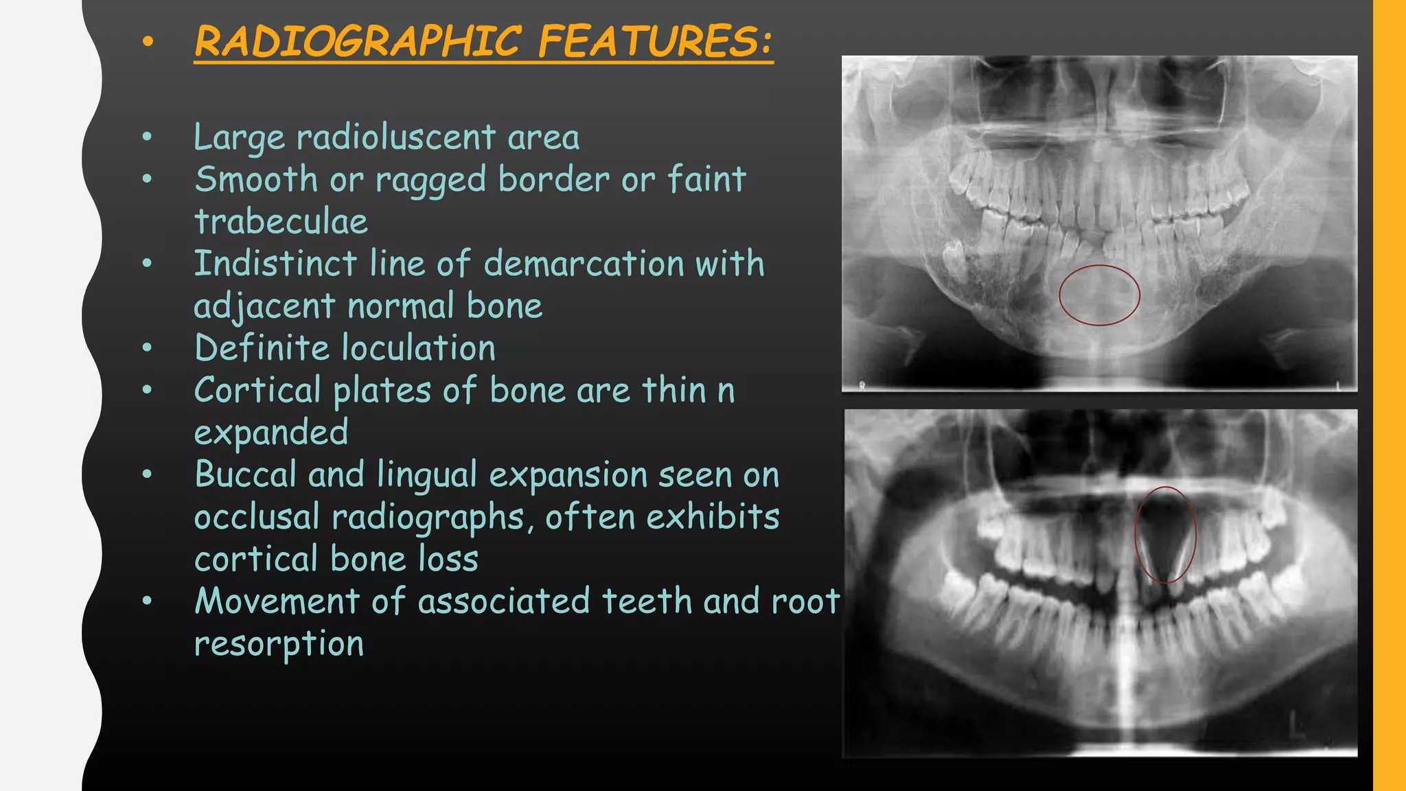 Peripheral and central giant cell granuloma | PPTX