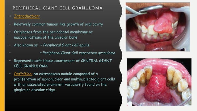 Peripheral and central giant cell granuloma