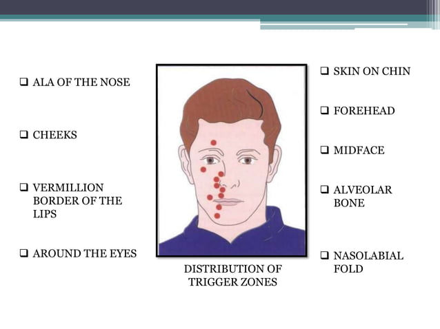 Trigger Zones Of Orofacial Region In Trigeminal Neuralgia