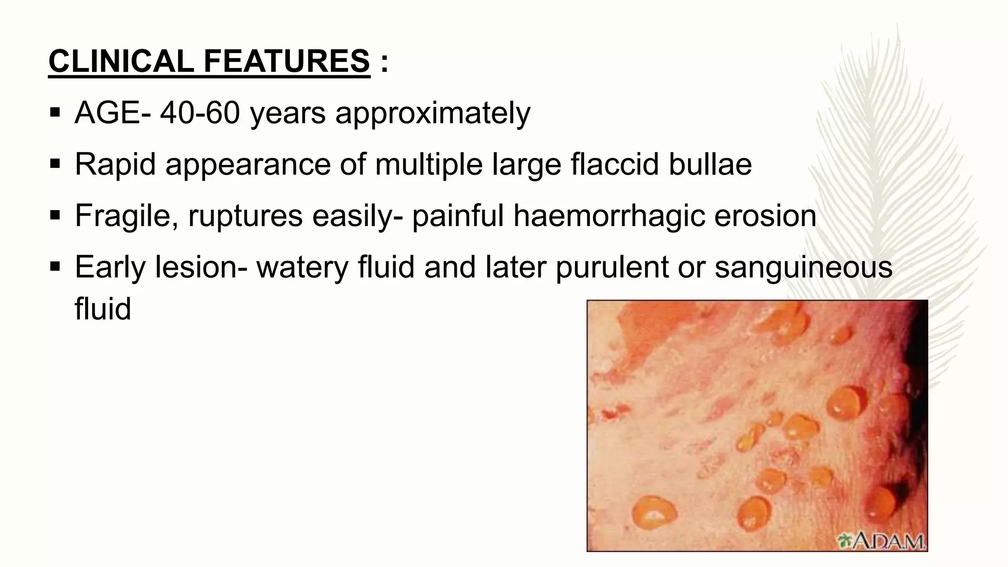 Oral pemphigus vulgaris | PPTX