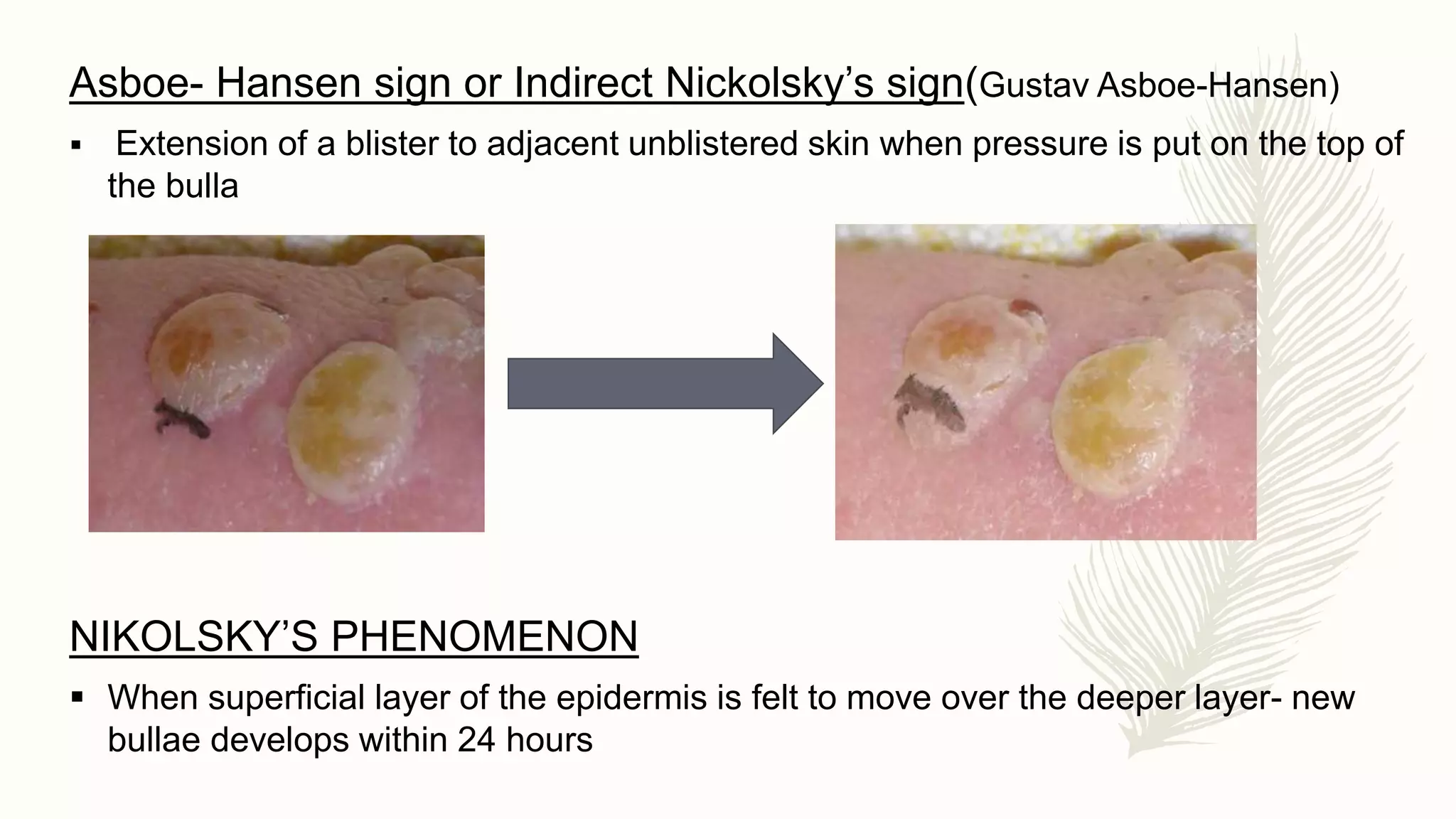 Oral pemphigus vulgaris | PPTX