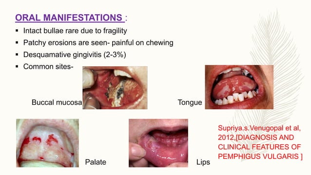 Oral pemphigus vulgaris | PPTX | Skin and Dermatology | Diseases and ...
