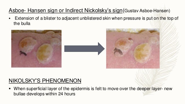 Oral pemphigus vulgaris