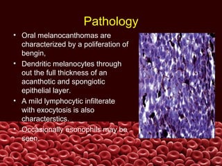 Oral pigmentation lesion | PPT