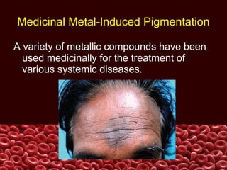 Oral pigmentation lesion | PPT