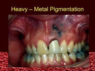 Oral pigmentation lesion | PPT