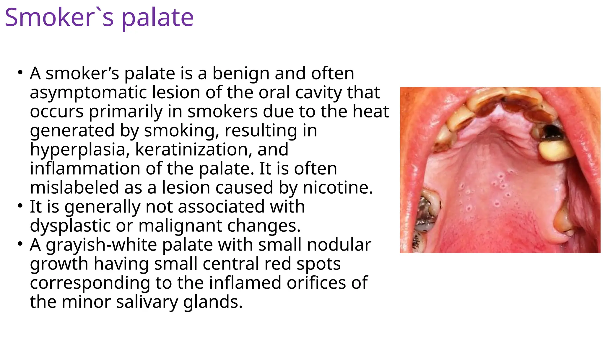 oral potentially malignant disorders opmd | PPTX