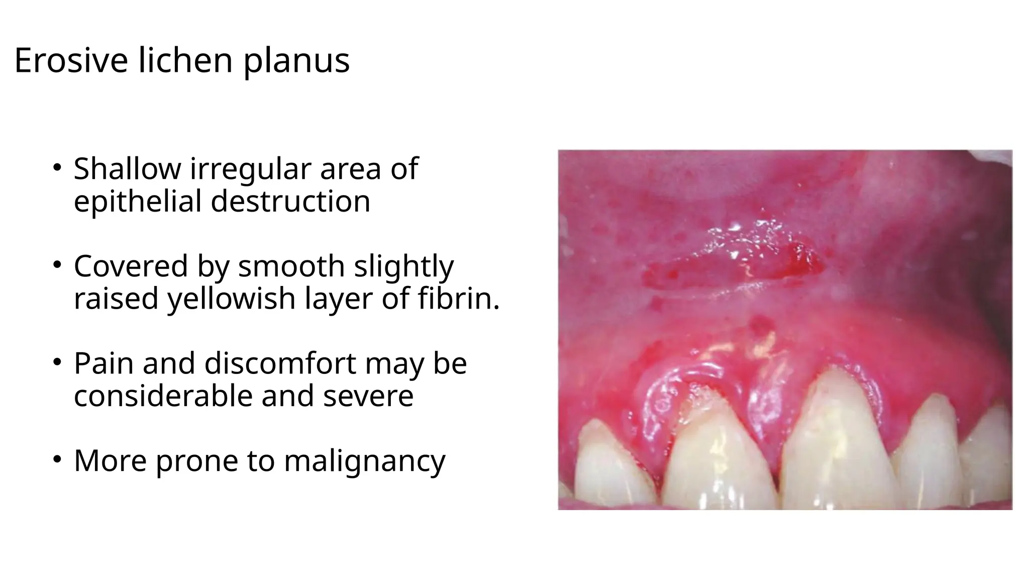 oral potentially malignant disorders opmd | PPTX