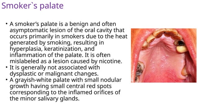 oral potentially malignant disorders opmd | PPTX