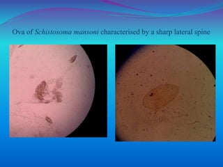 SCHISTONOMA MANSONI | PPTX