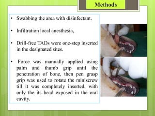 Histomorphometric and biomechanical analyses of Self-drilling ...