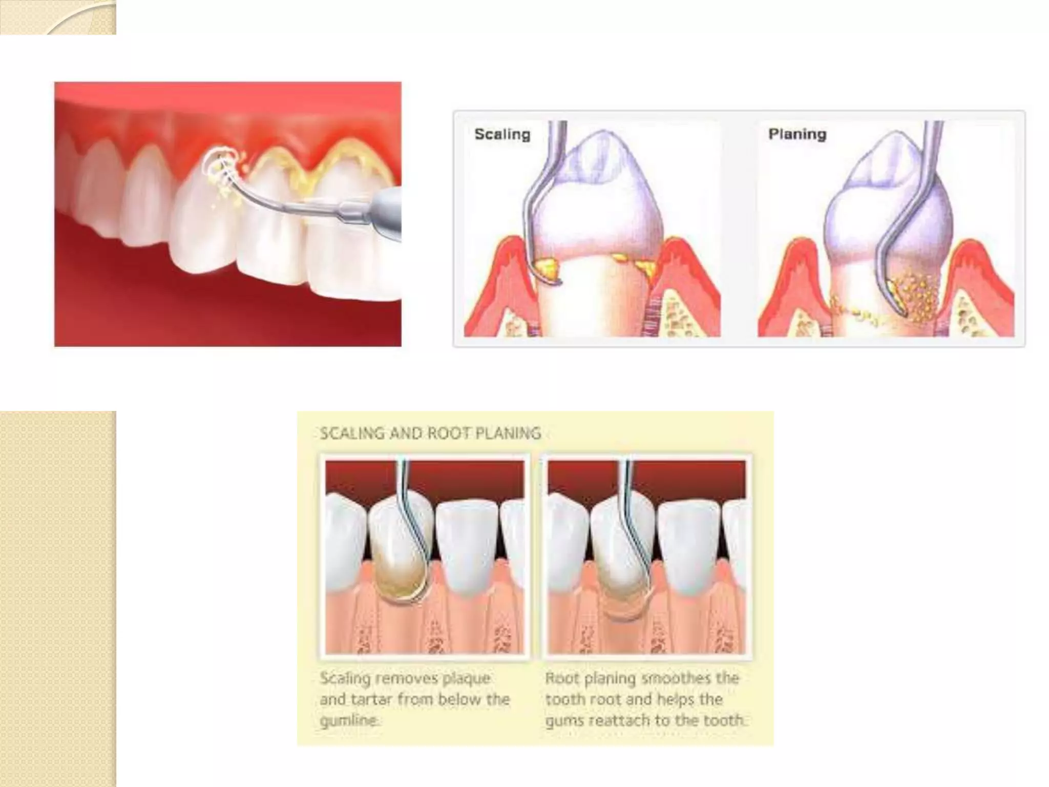 Oral prophylaxis | PPTX