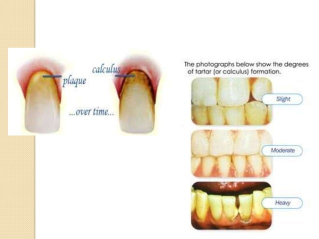 Oral prophylaxis | PPTX