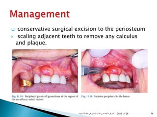 Oral pyogenic granuloma | PPTX