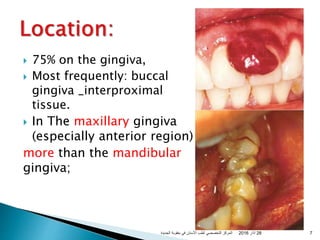 Oral pyogenic granuloma | PPTX