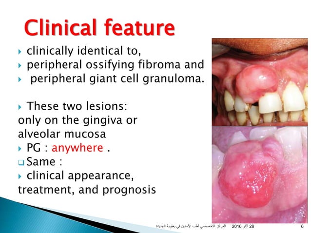 Oral pyogenic granuloma