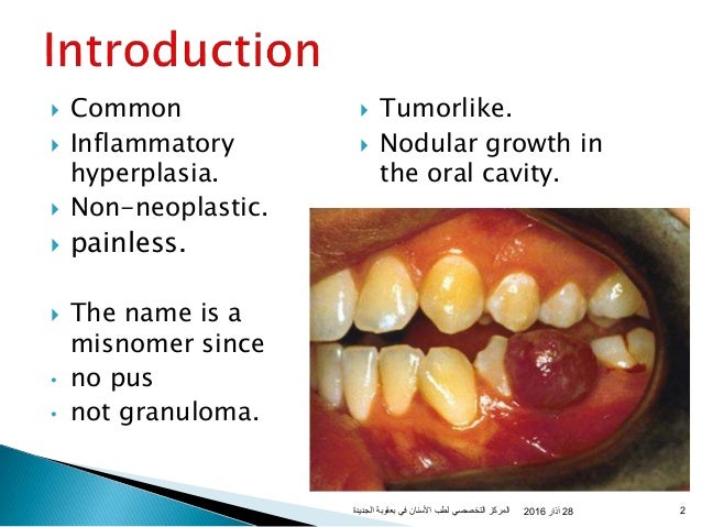 Pyogenic Granuloma Mouth _ Granulome Pyogénique Traitement – MOXG